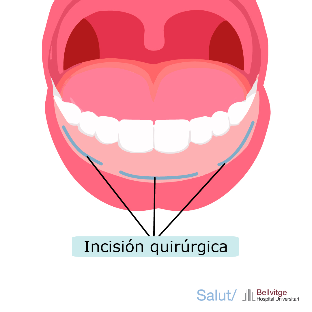 Tiroidectomía: principales detalles | Hospital de Bellvitge